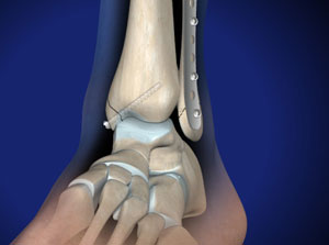 Ankle Fracture Surgery Piedmont Orthopedics | OrthoAtlanta