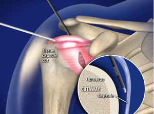 Arthroscopic Capsular Release Piedmont Orthopedics | OrthoAtlanta