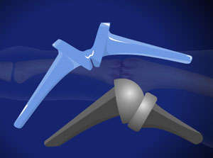 Artificial Joint Replacement of the Finger Piedmont Orthopedics ...