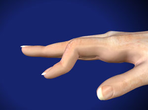 Boutonniere Deformity Piedmont Orthopedics | OrthoAtlanta