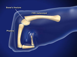 Boxer's Fracture Piedmont Orthopedics | OrthoAtlanta