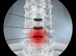 Discography (Thoracic) Piedmont Orthopedics | OrthoAtlanta