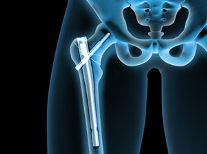 Femur Fracture Fixation (Stryker® Gamma Nail) Piedmont Orthopedics ...