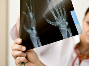 Fractures of the Hand (Metacarpal Fractures) Piedmont Orthopedics ...