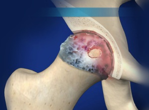 Degenerative Joint Disease of the Hip (Osteoarthritis of the Hip ...