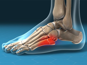 Jones Fracture Piedmont Orthopedics | OrthoAtlanta