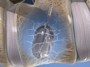 Kyphoplasty (Balloon Vertebroplasty) Piedmont Orthopedics | OrthoAtlanta