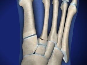 LisFranc (Midfoot) Fracture-Dislocation Piedmont Orthopedics | OrthoAtlanta