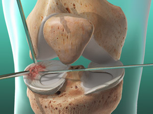 Meniscus Repair (Arthroscopic Technique) Piedmont Orthopedics ...