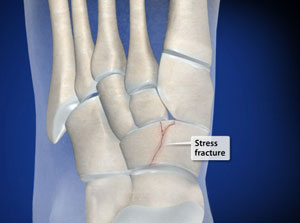 Navicular Stress Fracture Piedmont Orthopedics | OrthoAtlanta