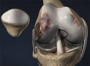 Avascular Necrosis (Osteonecrosis) of the Knee Piedmont Orthopedics ...