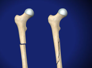 Pediatric Femoral Fractures Piedmont Orthopedics | OrthoAtlanta