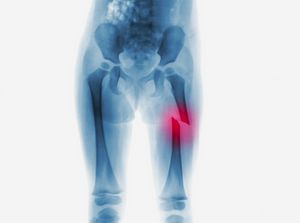 Femur Fractures in Children Piedmont Orthopedics | OrthoAtlanta