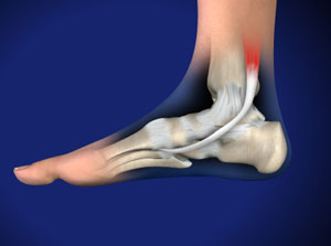 Posterior Tibial Tendon Dysfunction (PTTD) Piedmont Orthopedics ...