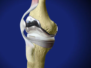 Revision Knee Surgery Piedmont Orthopedics | OrthoAtlanta
