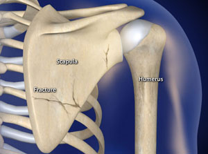 Fractures of the Shoulder Blade (Scapula) Piedmont Orthopedics ...