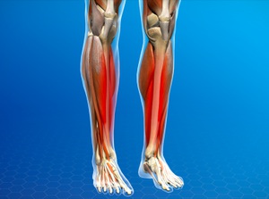 Shin Splints (Medial Tibial Stress Syndrome) Piedmont Orthopedics ...