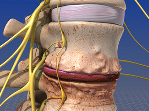 Spinal Infection Piedmont Orthopedics | OrthoAtlanta