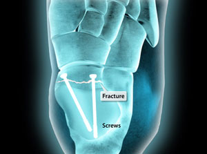 Talar Fracture Fixation (Open Reduction and Internal Fixation) Piedmont ...