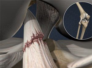 Anterior Cruciate Ligament Tear (ACL Tear) Piedmont Orthopedics ...