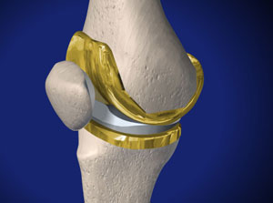Total Knee Replacement (Uncemented) Piedmont Orthopedics | OrthoAtlanta