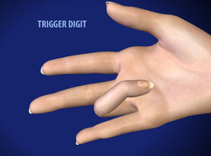 Trigger Digit Release Piedmont Orthopedics | OrthoAtlanta